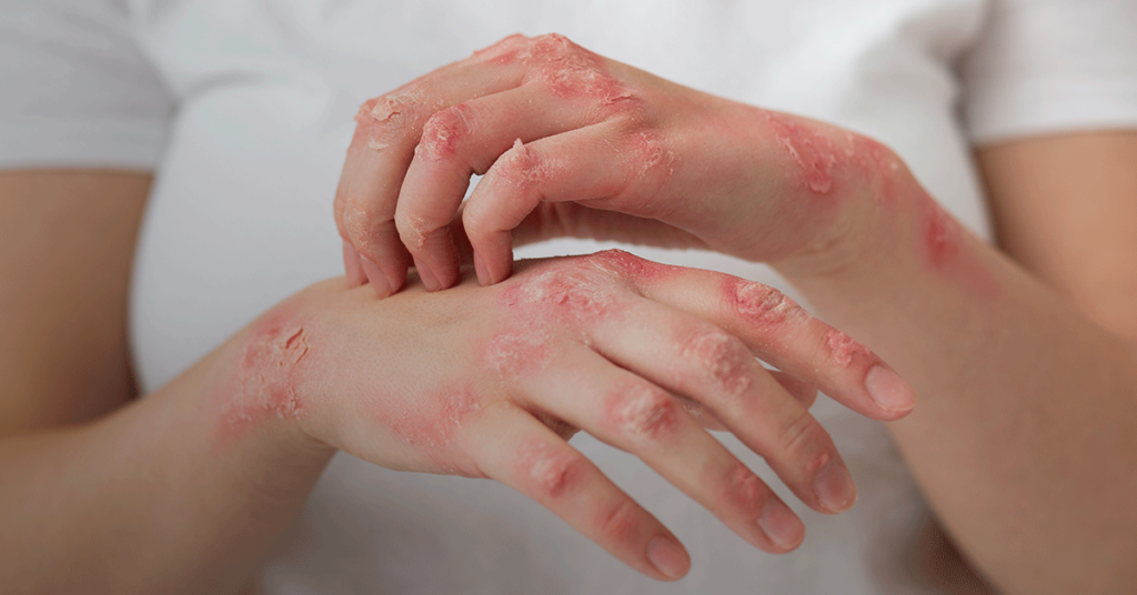 Doenças autoimunes: quando o inimigo é seu próprio organismo - Folha BV